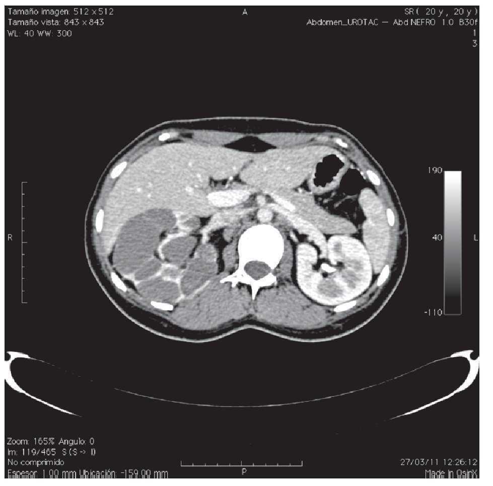 Manejo quirúrgico de extrofia vesical complicada con duplicación ...