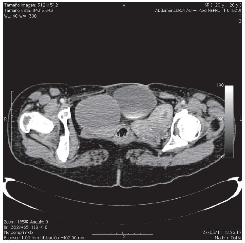 Manejo quirúrgico de extrofia vesical complicada con duplicación ...