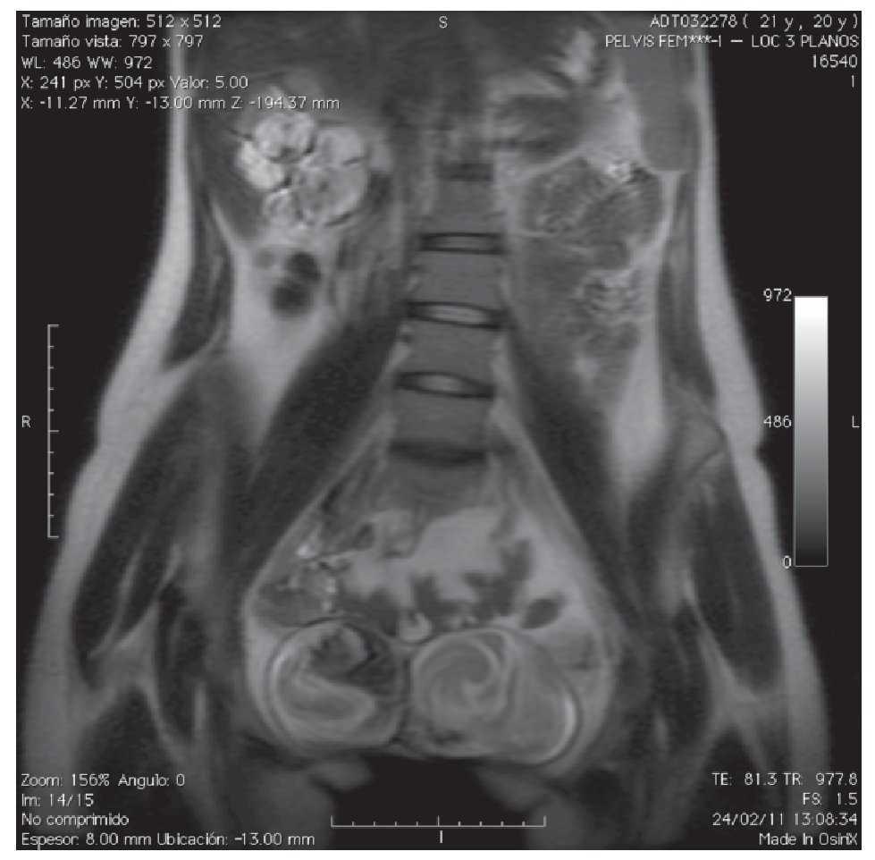 Manejo quirúrgico de extrofia vesical complicada con duplicación ...