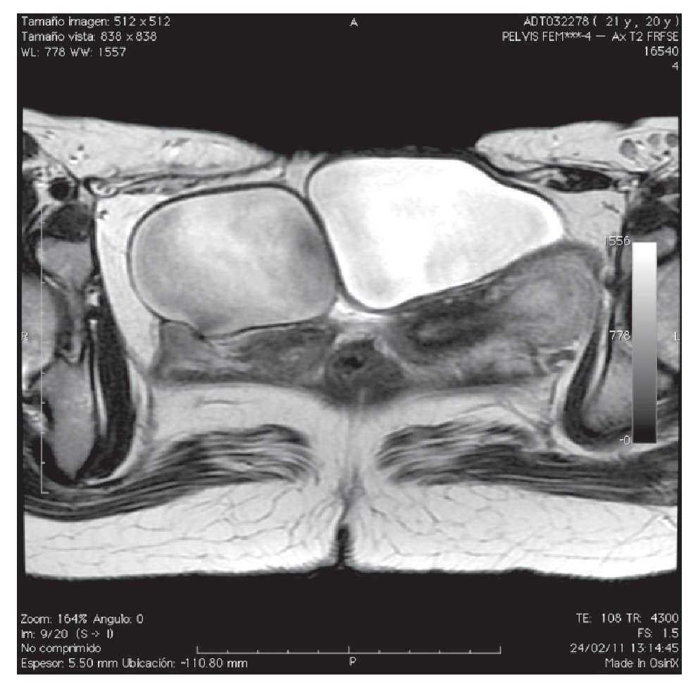 Manejo quirúrgico de extrofia vesical complicada con duplicación ...