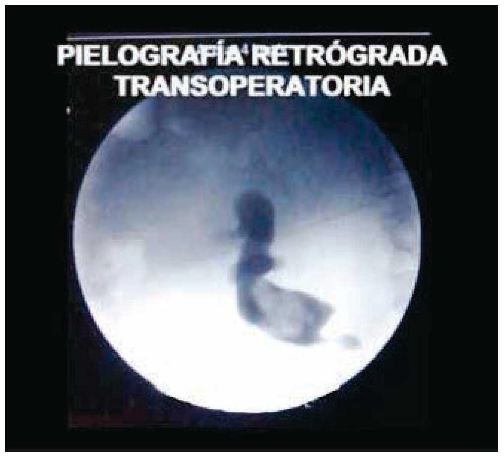 Nefrolitotomía percutánea en riñón en herradura | Revista Mexicana de ...
