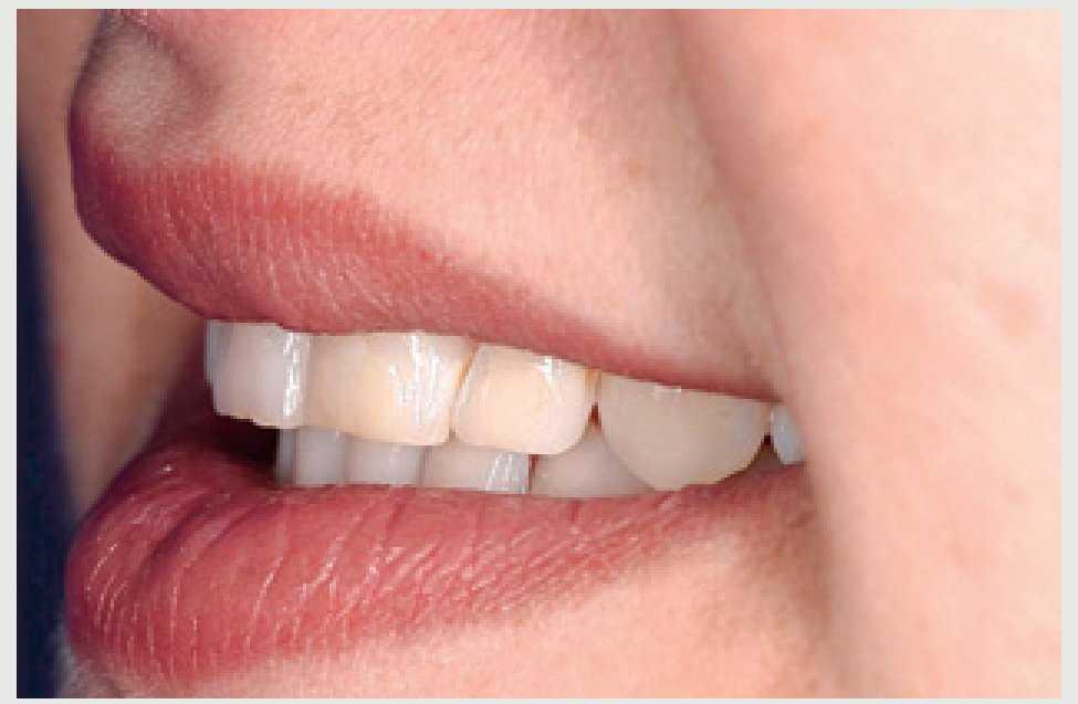 Insuficiente exposición dentaria en el sector anterior: Presentación de ...