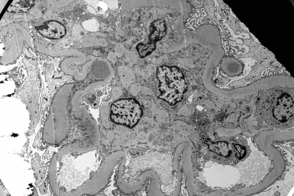 Kidney failure and diabetis. Diagnostic inertia? | Nefrología
