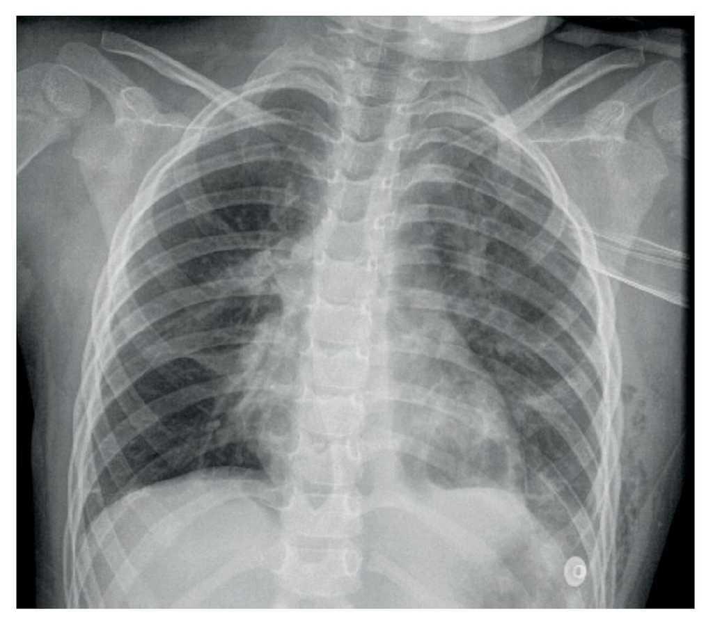 Lymphoid follicular bronchiolitis post-adenovirus infection | Boletín ...
