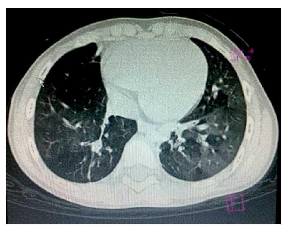 Lymphoid follicular bronchiolitis post-adenovirus infection | Boletín ...