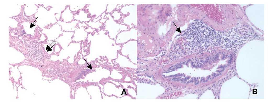 Lymphoid follicular bronchiolitis post-adenovirus infection | Boletín ...