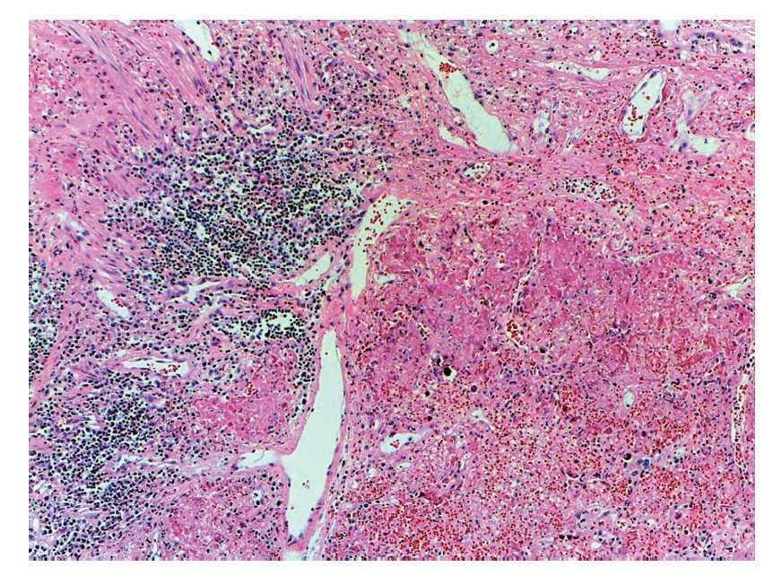 Postoperative cytomegalovirus necrotizing pneumonia in a preschooler ...