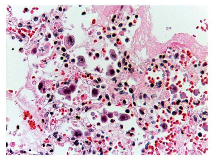 Postoperative cytomegalovirus necrotizing pneumonia in a preschooler ...