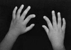 Falange en delta y sindactilia. Descripción de 23 casos en cuatro ...