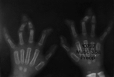 Falange en delta y sindactilia. Descripción de 23 casos en cuatro ...