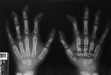 Falange en delta y sindactilia. Descripción de 23 casos en cuatro ...