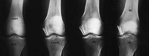 Osteocondritis disecante de la rodilla: Cambios artrósicos a largo ...