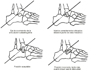 La artrodesis subastragalina con cuña libre en la estabilización precoz ...