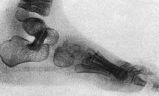 La artrodesis subastragalina con cuña libre en la estabilización precoz ...