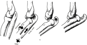 Inestabilidad del codo: Etiología, diagnóstico y tratamiento | Revista ...