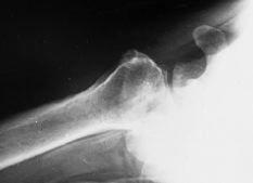 Fractura-luxación posterior de la cabeza humeral. Diagnóstico y ...