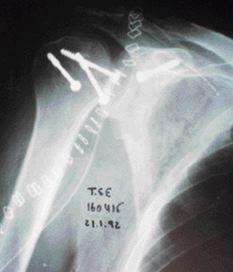 Fractura-luxación posterior de la cabeza humeral. Diagnóstico y ...