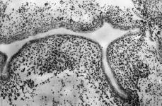 Casos clínicos Sarcoma botryoides de tracto genital femenino inferior ...