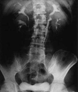 Urografía intravenosa | Medicina Integral