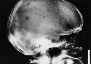 Lesiones osteolíticas en cráneo en paciente mayor | REEMO