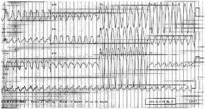 Taquiarritmias | Medicina Integral