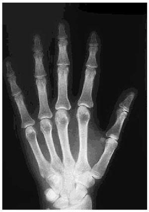 las lesiones de la mano en urgencias | Medicina Integral