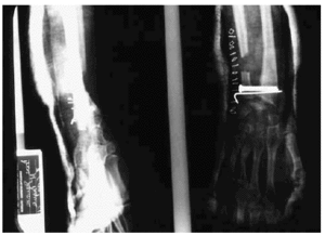 La técnica de Sauvé-Kapandji en los trastornos de la articulación ...