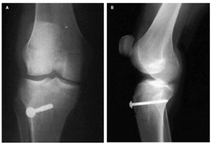 Valoración radiológica de la inestabilidad rotuliana | Revista de la ...