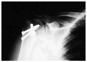 Fractura-luxación posterior de la cabeza humeral por electrocución ...