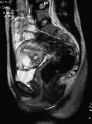 Mola invasora y abdomen agudo: a propósito de un caso | Clínica e ...