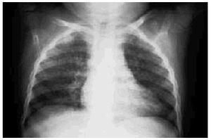Manifestaciones radiológicas de la tuberculosis pulmonar | Medicina ...