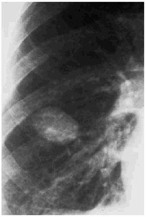 Manifestaciones radiológicas de la tuberculosis pulmonar | Medicina ...