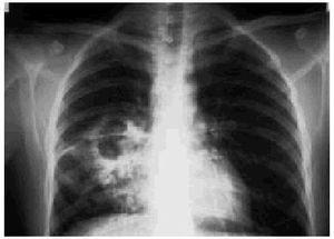 Manifestaciones radiológicas de la tuberculosis pulmonar | Medicina ...