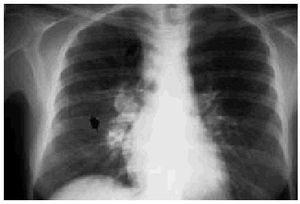 Manifestaciones radiológicas de la tuberculosis pulmonar | Medicina ...