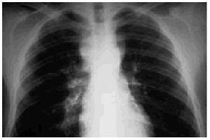 Manifestaciones radiológicas de la tuberculosis pulmonar | Medicina ...