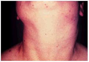 Tuberculosis e infección por el virus de la inmunodeficiencia humana ...