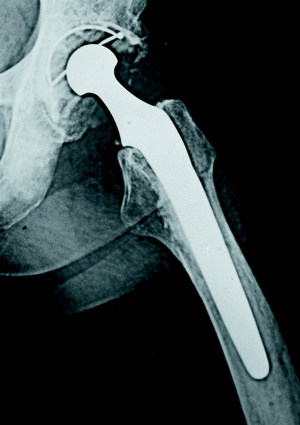 Tratamiento quirúrgico de las fracturas patológicas metastásicas del ...