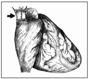 Pitfalls in Left Atrial Reduction. Superior Neo-Cava with Pericardium ...