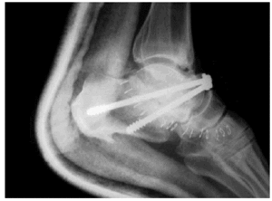 Valoración de la artrodesis subastragalina en el tratamiento de la ...