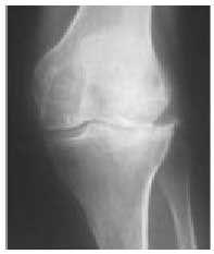 Gonartrosis | Medicina Integral