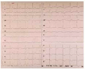 Acute Pulmonary Edema with Normal Coronary Arteries: Mechanism ...