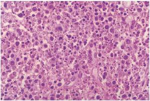 Linfadenitis necrosante de Kikuchi-Fujimoto y su asociación con el ...