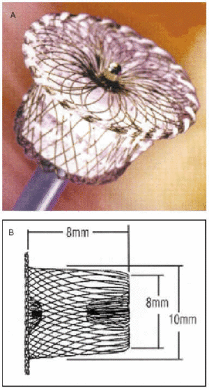 Transcatheter Closure of Patent Ductus Arteriosus Using the Amplatzer ...