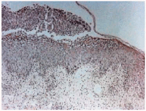 Psoriasis pustulosa anular | Actas Dermo-Sifiliográficas