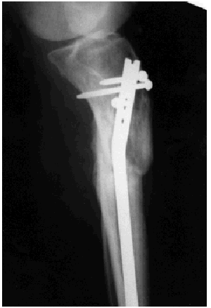 Tratamiento de las fracturas cerradas de la diáfisis tibial mediante ...