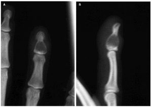 Encondroma solitario en falange distal del cuarto dedo de la mano ...