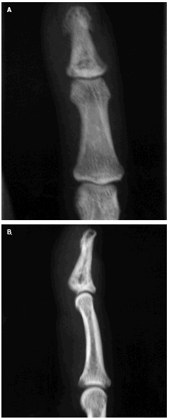 Encondroma solitario en falange distal del cuarto dedo de la mano ...