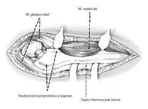 Cubierta ósea anterolateral para revisión de artroplastia de cadera ...