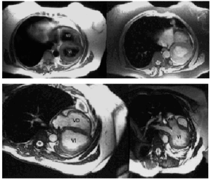 Extreme Levocardia | Revista Española de Cardiología