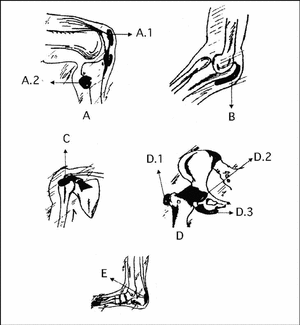 Bursitis: análisis clínico de 52 casos | Revista Española de Reumatología